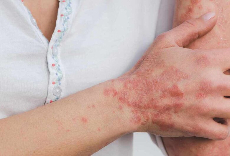 Psoríase: entenda causas, sintomas e como funciona o tratamento ...