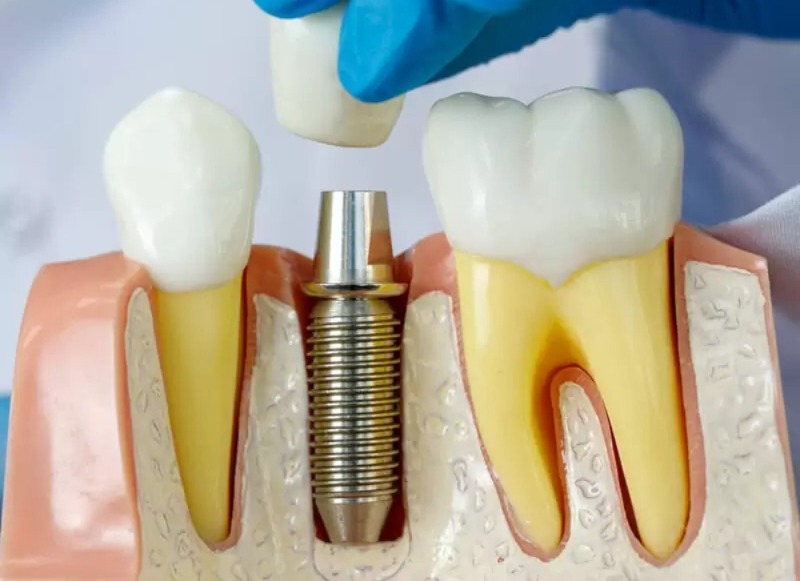 5 coisas que você precisa saber antes de optar por fazer implante ...